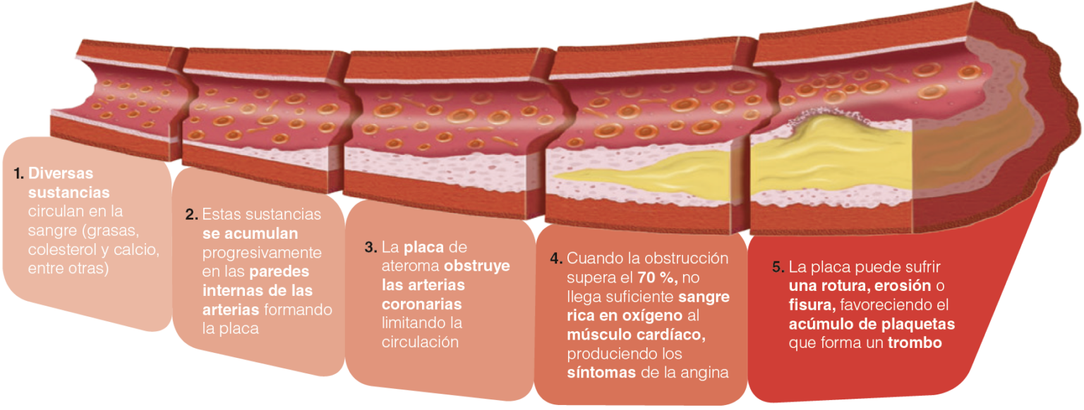 Consejos para pacientes con angina de pecho | Menarini España